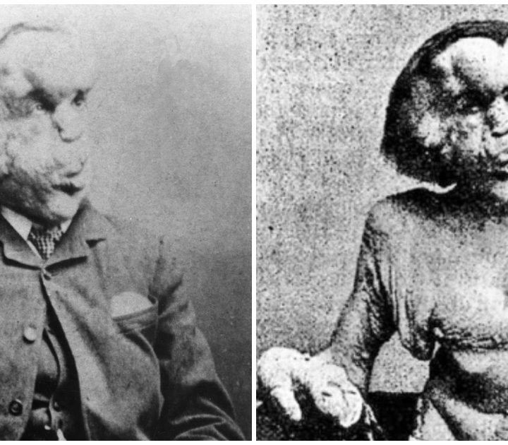 The Heartbreaking Story Of Joseph Merrick, The Elephant Man, Who Sought ...
